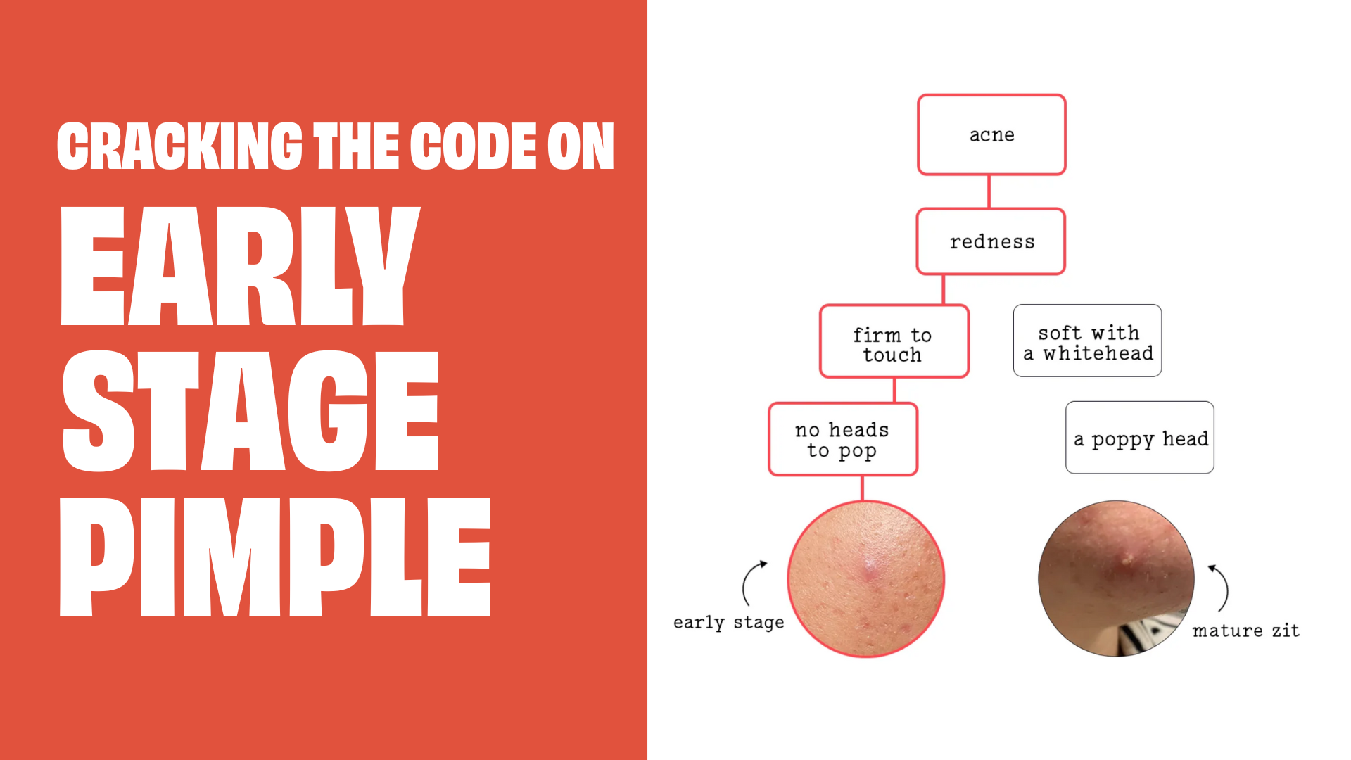 What Does Early Stage Acne Look Like? – Breakfree Skincare