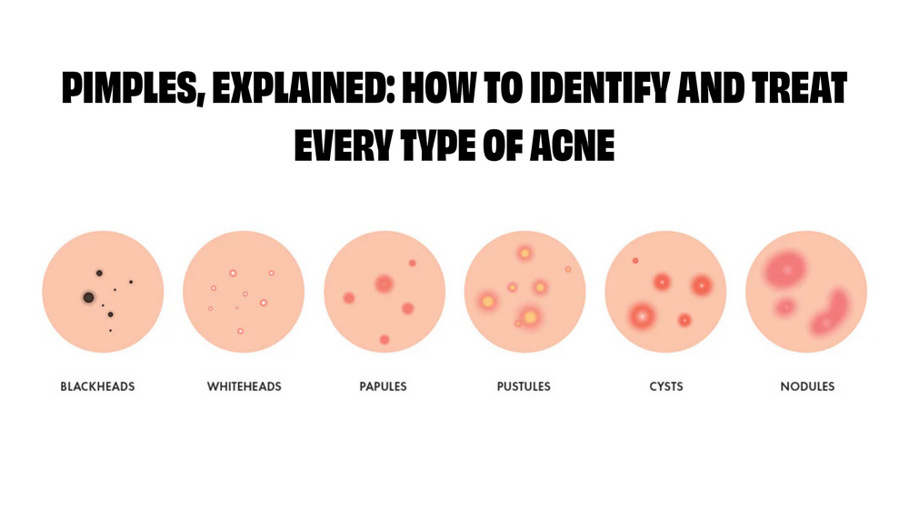 Pimples, Explained: How to Identify and Treat Every Type of Acne ...